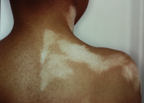 PICT0001 | Segmental Nevus | Dr. Ken Hashimoto | Wayne State University SOM - Dermatology Image ...